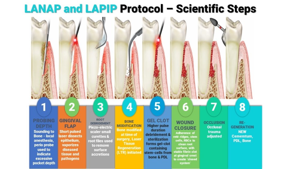 LANAP Laser Dentistry & Periodontal Therapy - Oyster Bay, Long Island NY